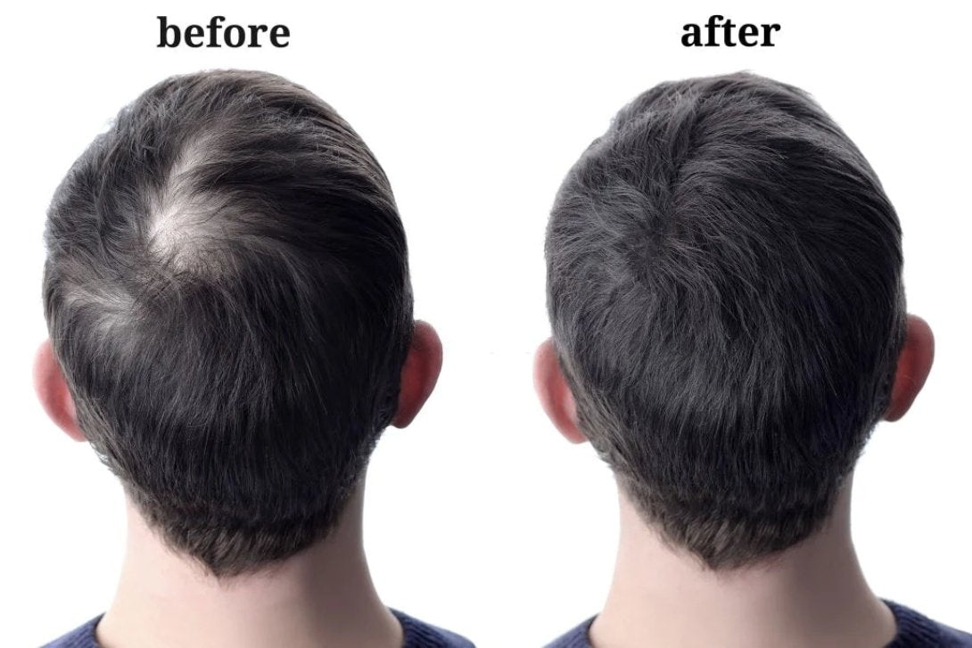 DHT Blockers Guide for Natural Hair Loss Prevention and Treatment ...