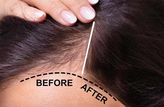 Microneedling for Hair Loss Treatment and Dermaroller Guide – HAIRMETTO